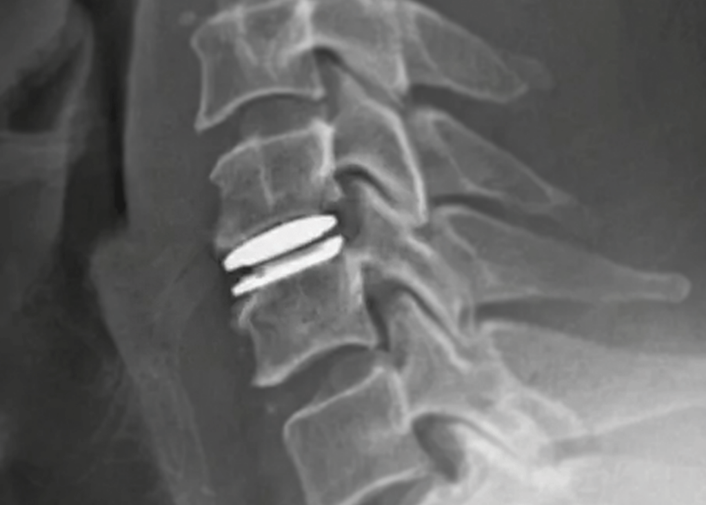 Procedures – Center for Spine Surgery